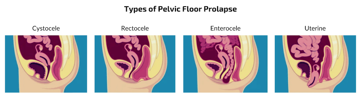 Identifying and Treating Pelvic Organ Prolapse